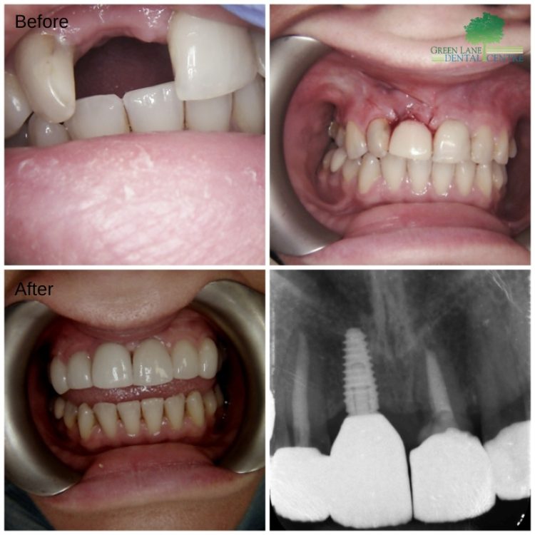Smile Gallery - Ardent Sidcup Dental Clinic | NHS and Private