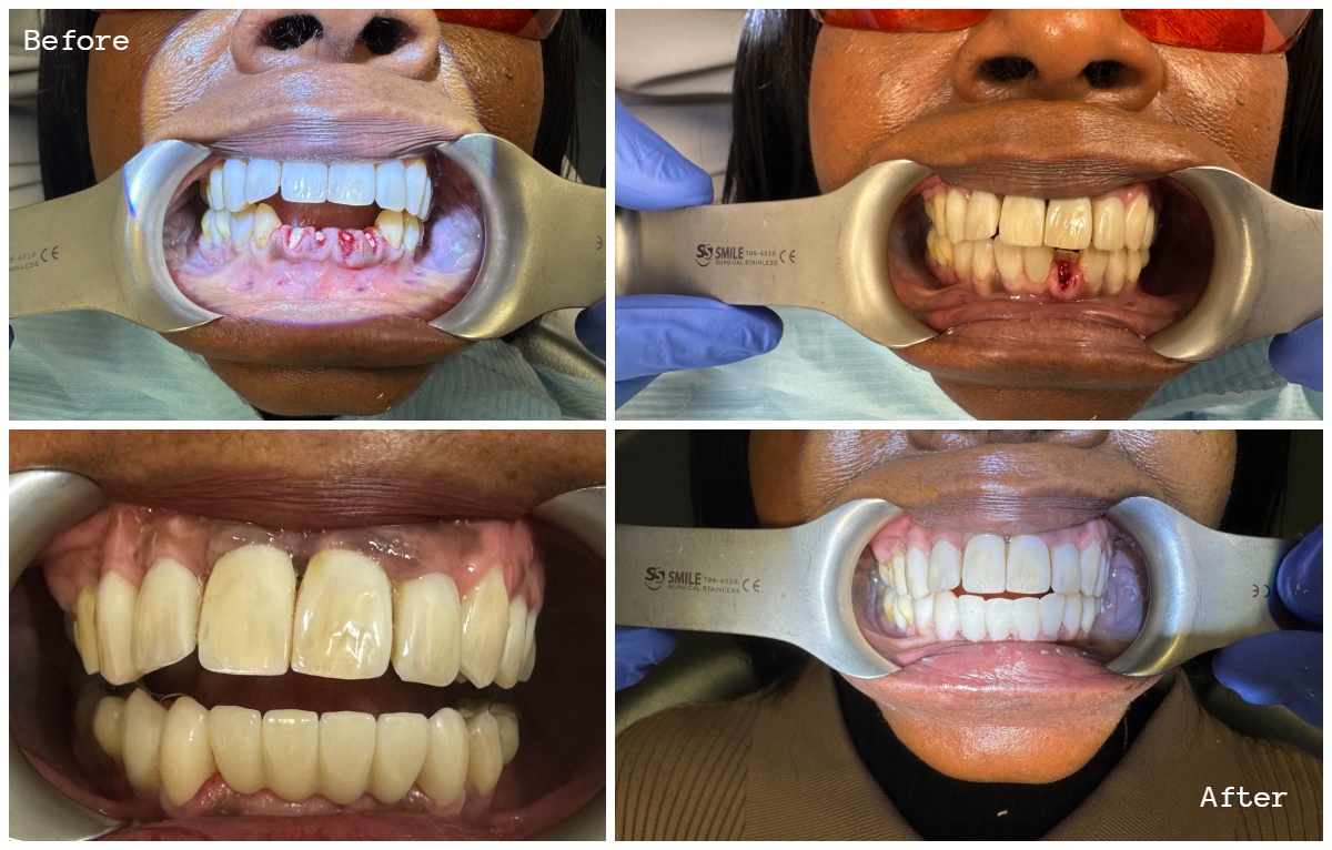 Dental Bridge Smile Gallery - Ardent Sidcup Dental Clinic | NHS and Private