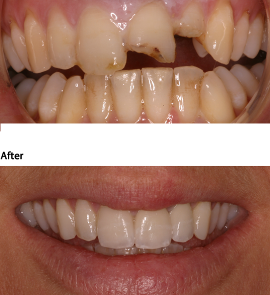 Dental Crown Smile Gallery - Ardent Sidcup Dental Clinic | NHS and Private