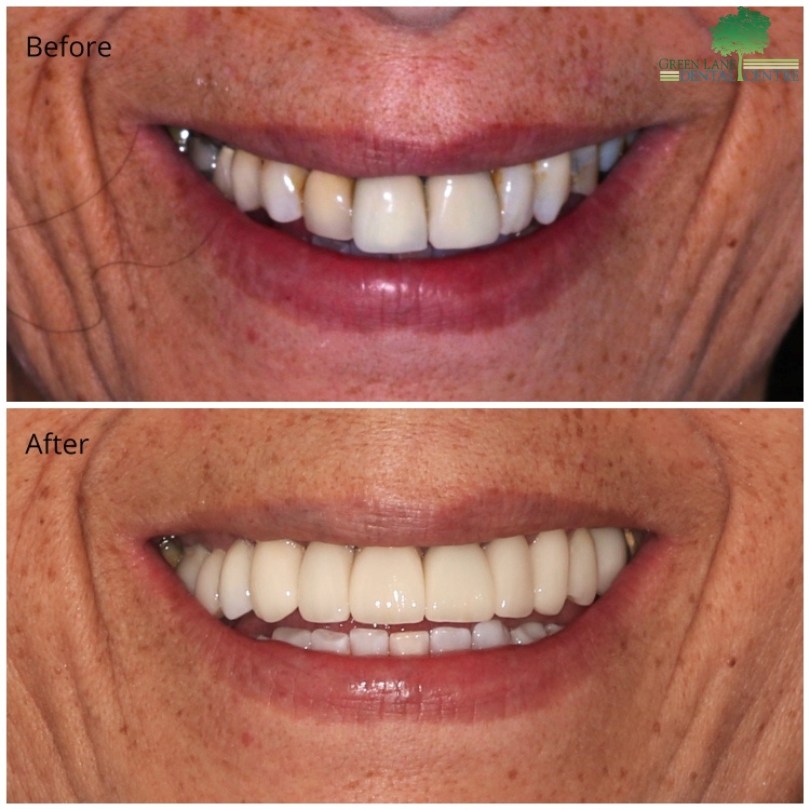 Dental Crown Smile Gallery - Ardent Sidcup Dental Clinic | NHS and Private