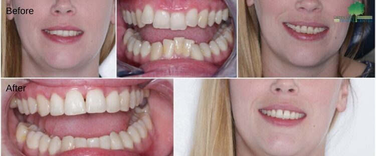 Six Month Smile Gallery - Ardent Sidcup Dental Clinic | NHS and Private