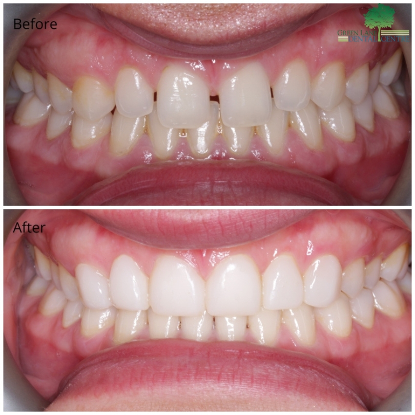 Dental Veneers Smile Gallery - Ardent Sidcup Dental Clinic | NHS and ...