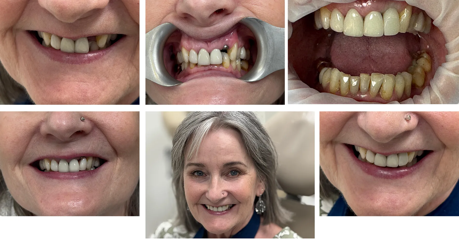 Smile Gallery - Ardent Sidcup Dental Clinic | NHS and Private