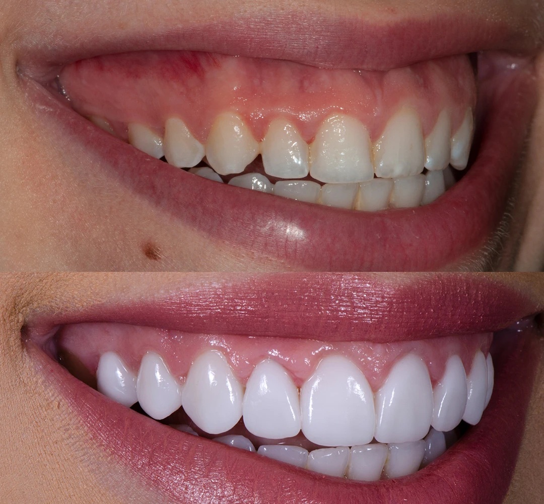 Laser Gum Contouring | Benefits, Before & After, Cost