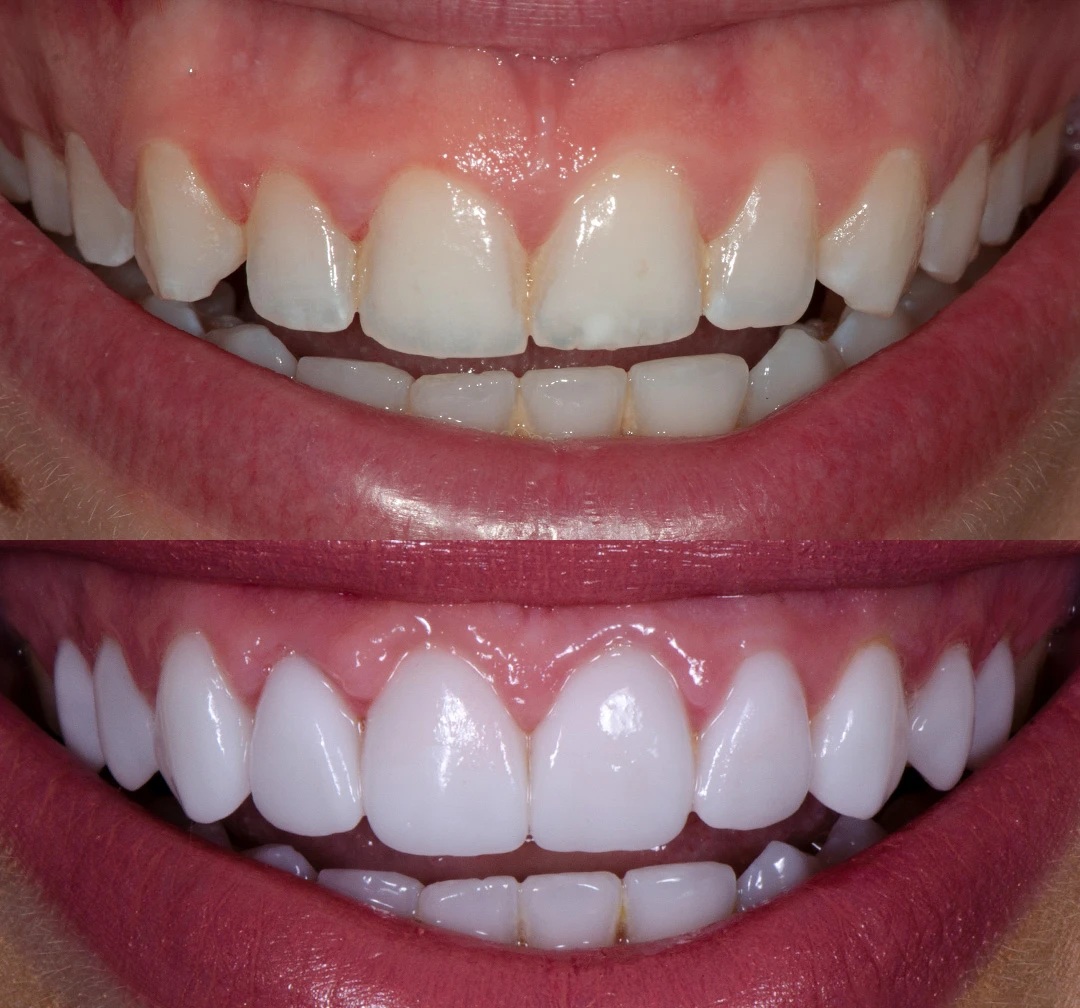 Laser Gum Contouring | Benefits, Before & After, Cost