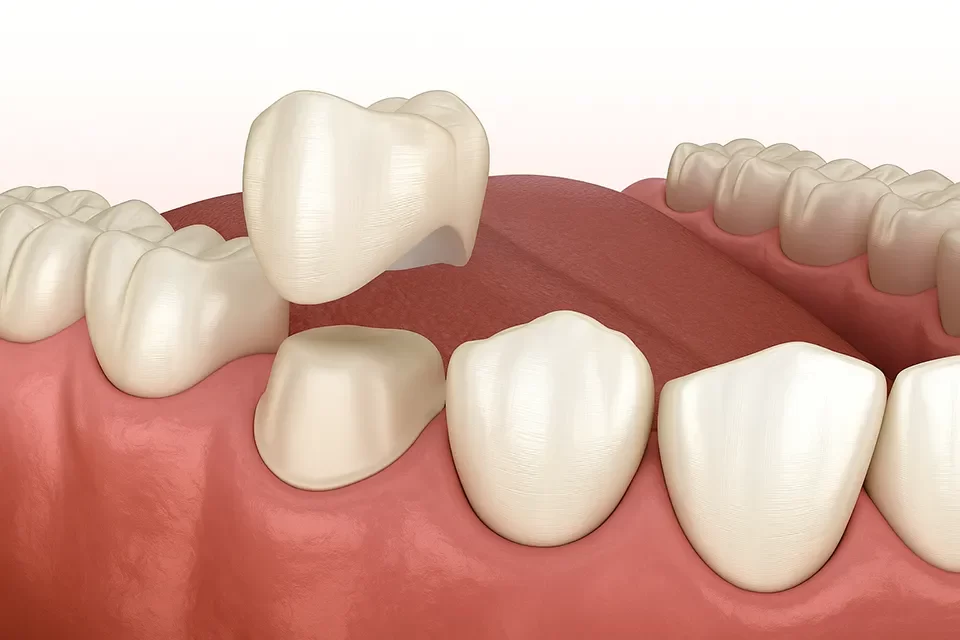 Dental Crowns for Strong & Natural-Looking | Ardent Sidcup